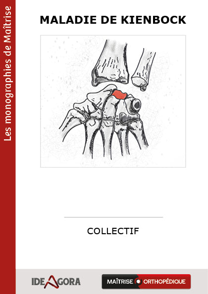 Maladie de Kienbock – Maîtrise Orthopédique